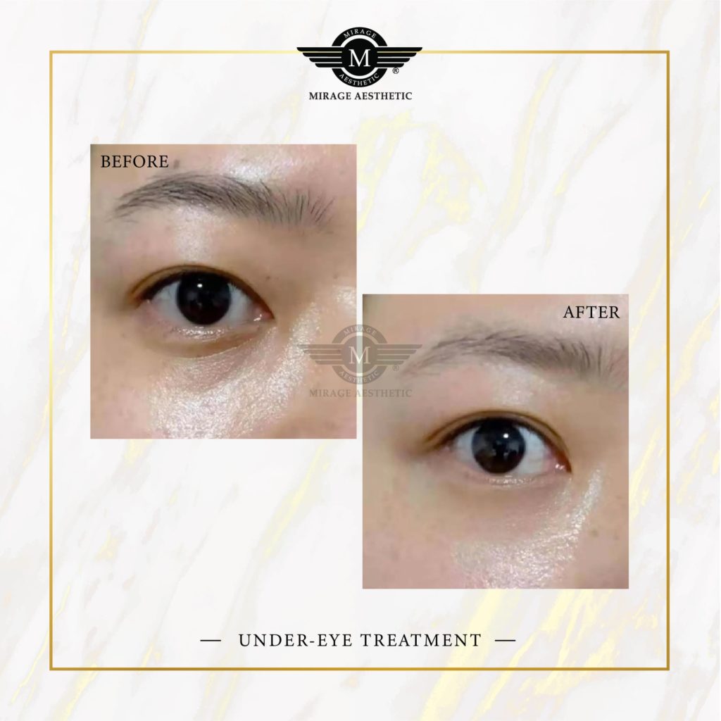 EYE REVIVE TREATMENT- Mirage Aesthetic